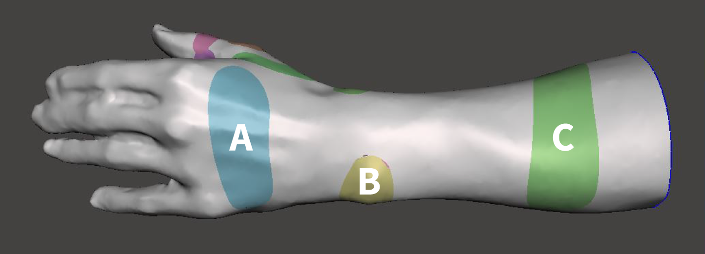 Evaluatie 3D handorthese | OIM Orthopedie